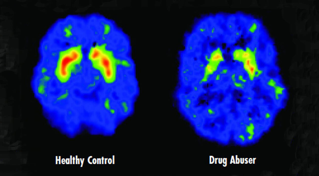 Reducing the Pull of Memories to Fight Drug Addiction Relapse | Pfizer